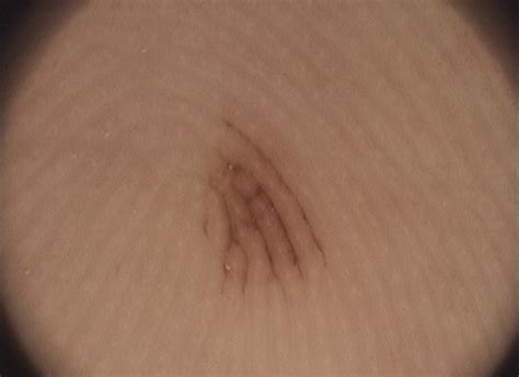 Dermoscopic Image Of Acral Melanocytic Nevus With Typical Parallel