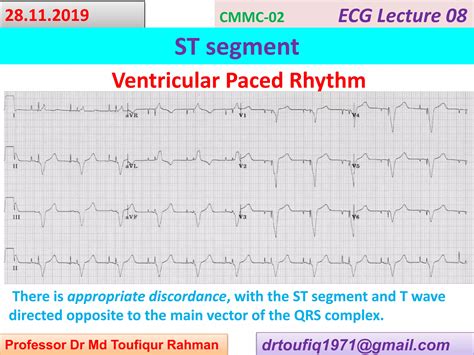 Ecg St Segment Ppsx