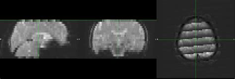 Gre Fieldmap Unwarping Introduces Artifacts To Top Bottom Slices Within Fsl Feat Neuroimaging