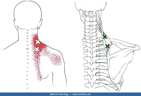 Myofascial Pain Syndrome Medlink Neurology