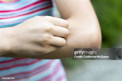 Tick Bite Image Photos And Premium High Res Pictures Getty Images