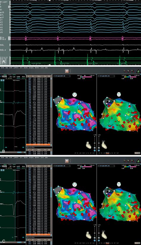 Electroanatomic Mapping For Arrhythmias Clinical Tree