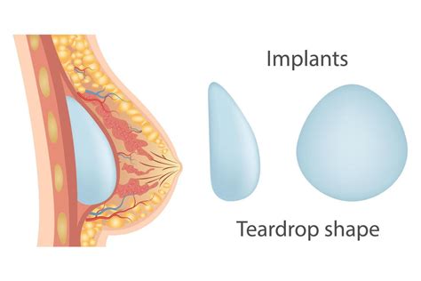 Breast Augmentation With Implant Or Breast Surgery Injection Of