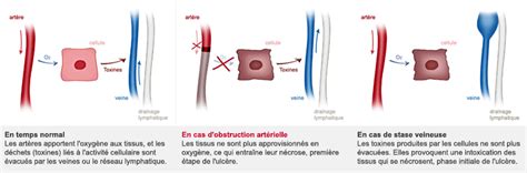 Ulcère De Stase Veineuse Vs Ulcère Artériel
