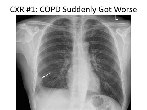 Ppt Copd Exacerbations Powerpoint Presentation Free Download Id 3997751