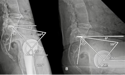 The Dorr Classification For Spinopelvic Functional Safe Component
