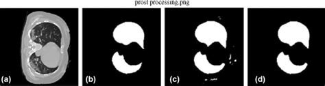 Post Processig After Lung Parenchyma Segmentation Download Scientific Diagram