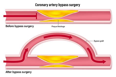 Coronary Artery Bypass Of The Human Heart Blood Vessels That Have