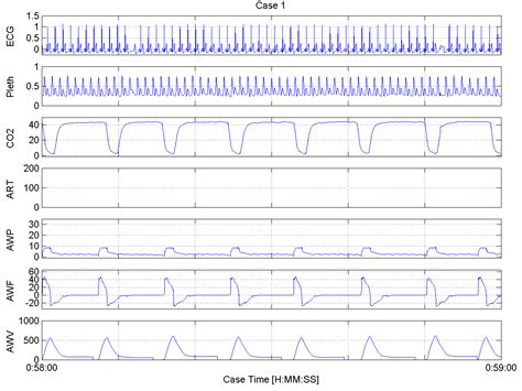Case 1 Waveform Plots 60 Second Plots