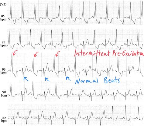 Cardiac Tamponade Ecg Signs