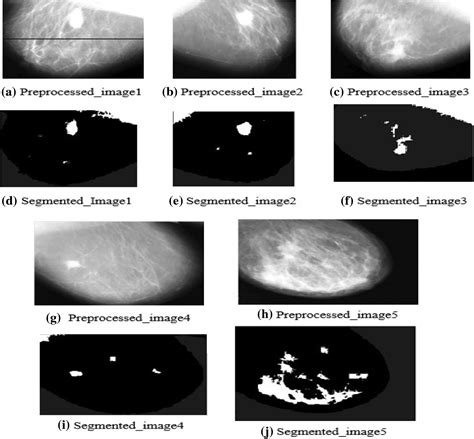 Adaptive Resource Allocation Neural Network Based Mammogram Image Segmentation And Classification