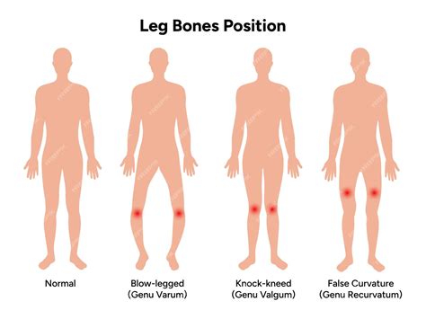 Premium Vector Leg Bones Position Blowlegged Knockkneed Face Curvature