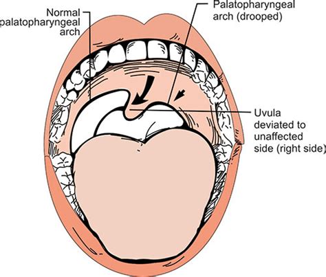 Uvula Deviation