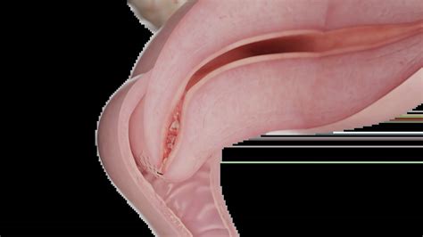 Cervicitis Causes Symptoms Signs Diagnosis And Treatment