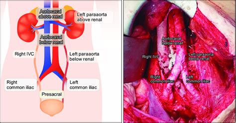 Surgical Areas Of Paraaortic Lymph Node Dissection Ivc Inferior Vena
