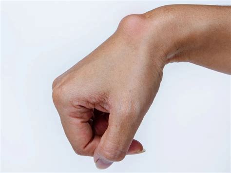 Sarcoma Symptoms Stages And Treatment Options Medtour