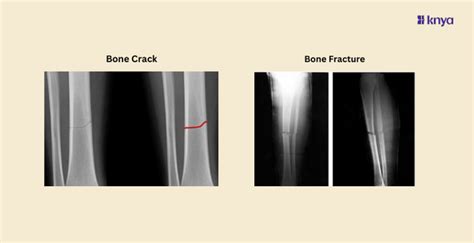Understanding The Difference Between Crack And Fracture Knya