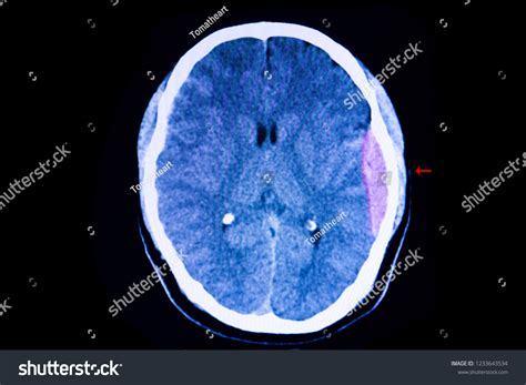 Brain Swelling Over Royalty Free Licensable Stock Photos Shutterstock