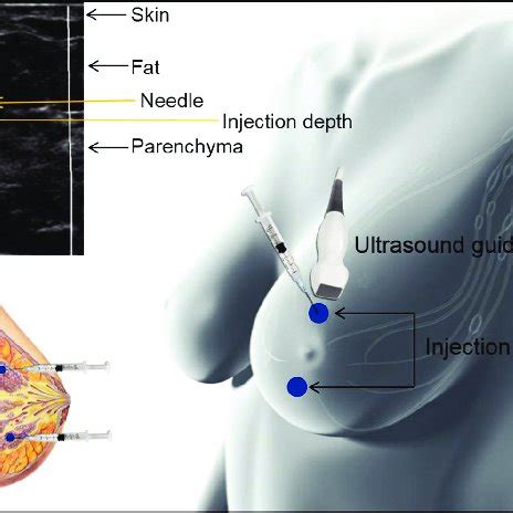Schematic Model Of The Modified Injection Techniques Download Scientific Diagram