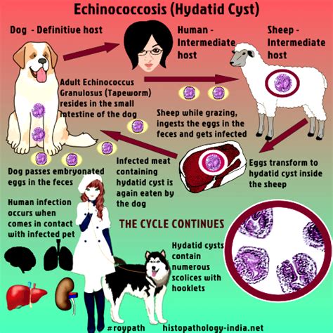Pathology Of Echinococcosis Hydatid Disease Dr Sampurna Roy Md