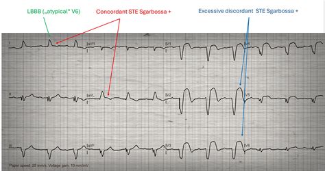 Sgarbossa Criteria Ecg Guru Instructor Resources
