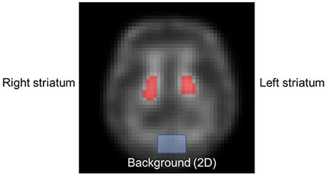Frontiers Generative Adversarial Network Based Attenuation Correction For 99mtc Trodat 1 Brain