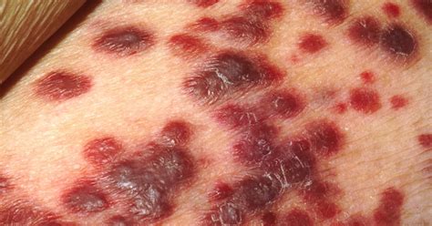 Ways To Treat Kaposis Sarcoma