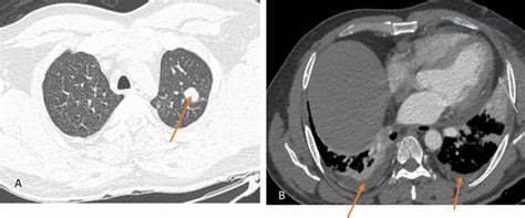 A Axial High Resolution Ct Hrct Image Shows Well Defined Nodule In Download Scientific