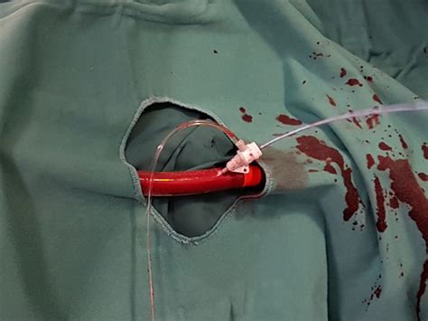 The 5 F Sheath Inserted In The Ecmo Arterial Line Download Scientific Diagram