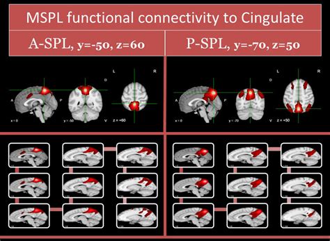 Title Resting State Functional Connectivity Analysis Examining