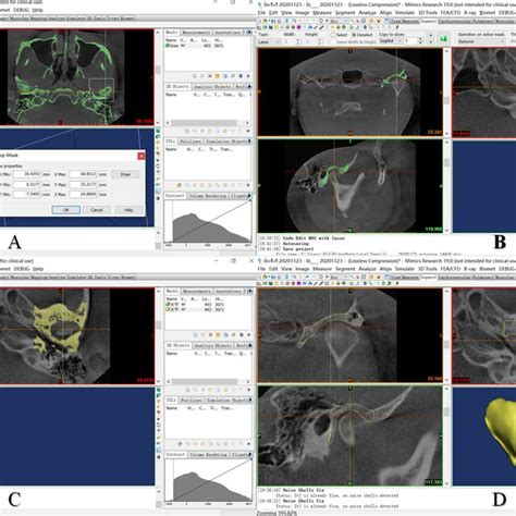 Reconstruction Of The Articular Fossa A Use Of The Crop Mask Command