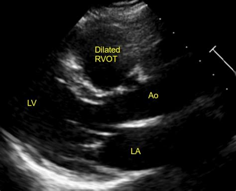 Multiple Echo Views In Emf Dilated Rvot Rv Apical Dimple And Fibrosis