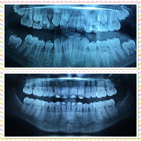 Dental Occlusion And Tmj The Interrelationship Fundamental Concepts Finer Details And
