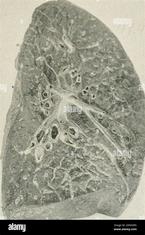Diseases Of The Chest And The Principles Of Physical Diagnosis Amarked Lowering Of