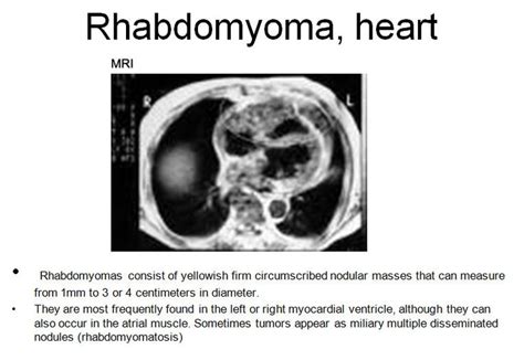 Pin By Nonas Arc On Rhabdomyomas Of The Heart Types Of Tumors Tumor