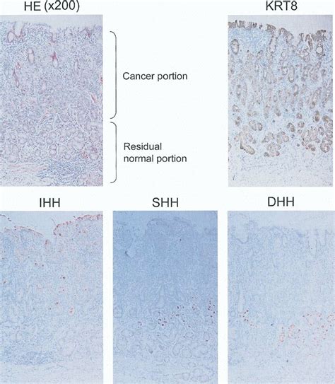 Presence Of Normal Gastric Mucosa In Diffuse Type Gastric Cancer Download Scientific Diagram