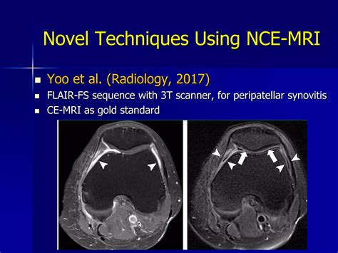 Imaging Of Synovitis In Oa Pptx