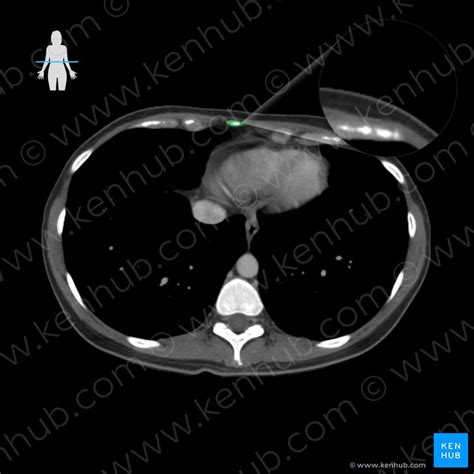 Xiphoid Process Processus Xiphoideus Kenhub