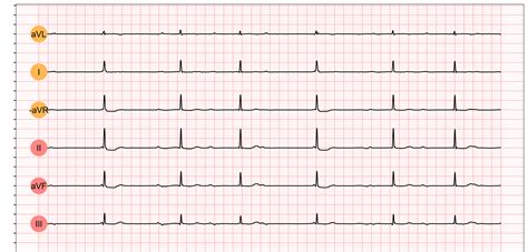 Third Degree Heart Block