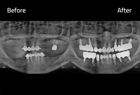 무치악 전체 임플란트 치료 전·후 서울스마트치과의원