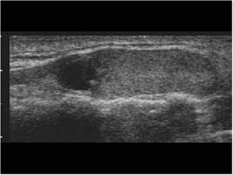 Head And Neck 41 Thyroid Gland Case 411 Thyroid Congenital Abnormalities Ultrasound Cases