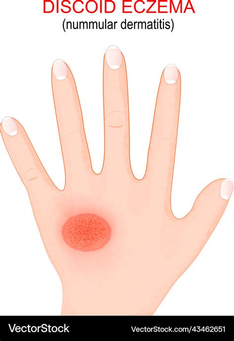 Nummular Dermatitis Discoid Eczema Royalty Free Vector Image Nummular Dermatitis Discoid Eczema Royalty Free Vector Image