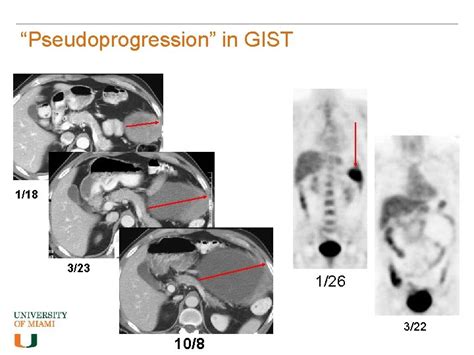 Overview Of Gist And Its Medical Management I