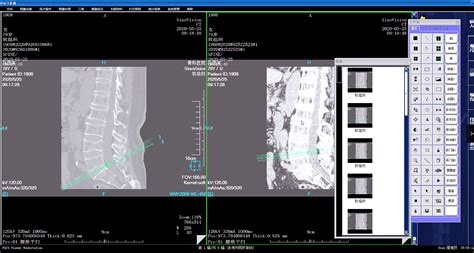 医院pacs系统源码（三维多平面重建、三维容积重建、三维表面重建、三维虚拟内窥镜） 阿里云开发者社区
