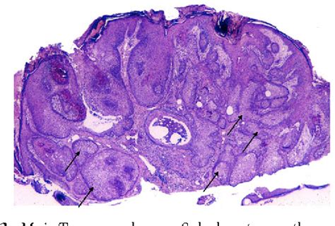 Figure 3 From Muir Torre Syndrome Mts An Update And Approach To