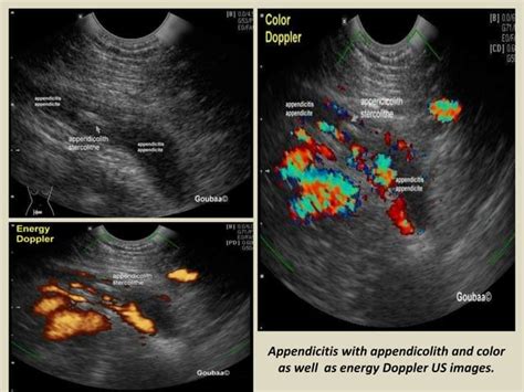 Presentation1pptx Ultrasound Examination Of The Appendix Pptx