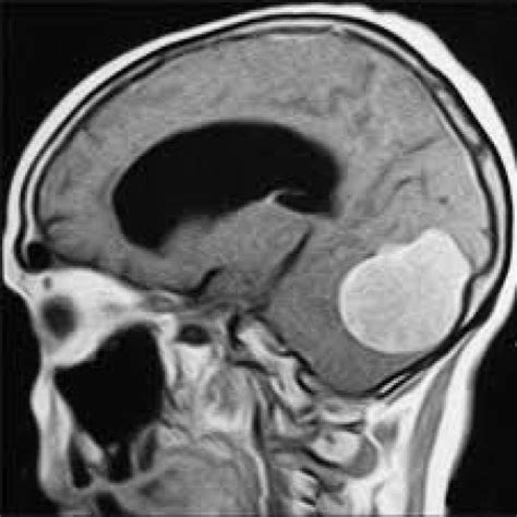Brain Tumor Object Detection Dataset By Reninda