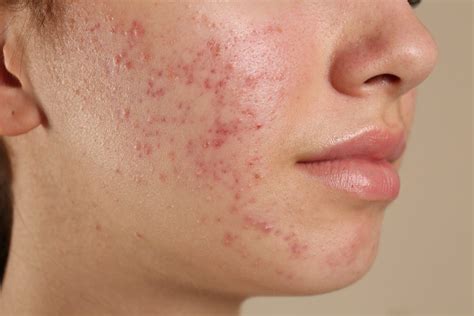 Acne Skin Herbal Reality