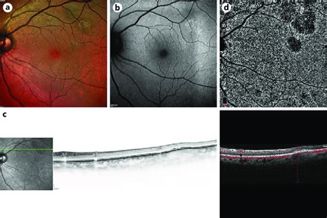 The Left Eye Of A Patient Female 67 Years Affected By Choroidal