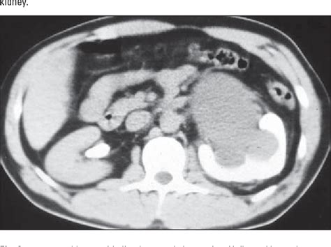 Figure 4—29 From Nephrographic And Pyelographic Analysis Of Ct Urography Principles Patterns